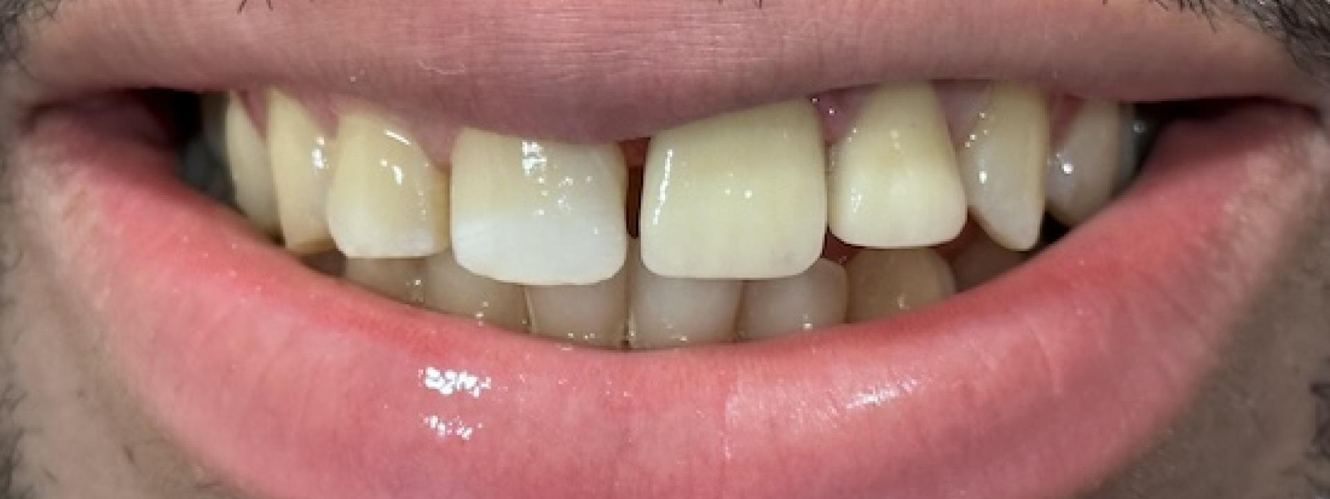 Dental Bonding | Excel Dentistry